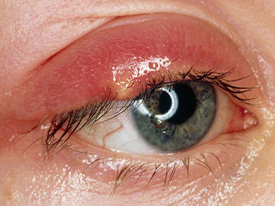 Cancro mole - Sintomas, tratamento e prevenção! - Seu Guia de Saúde