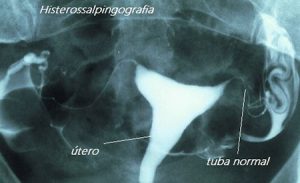 Histerossalpingografia - O que é? Como funciona? - Seu Guia de Saúde