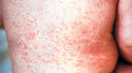 Exantema (Súbito e Viral) - O Que é? Tratamento, Causas, Prevenção!