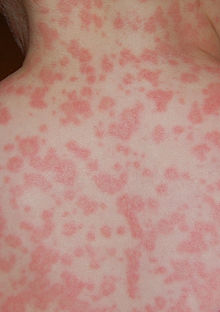 Exantema (Súbito e Viral) - O Que é? Tratamento, Causas, Prevenção!