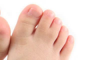 Sindactilia - O Que é? Causas, Sintomas, Tipos, Tratamento, Cirurgia!