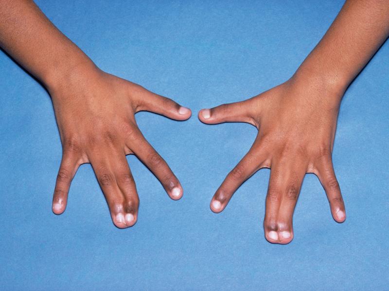 Sindactilia - O Que é? Causas, Sintomas, Tipos, Tratamento, Cirurgia!